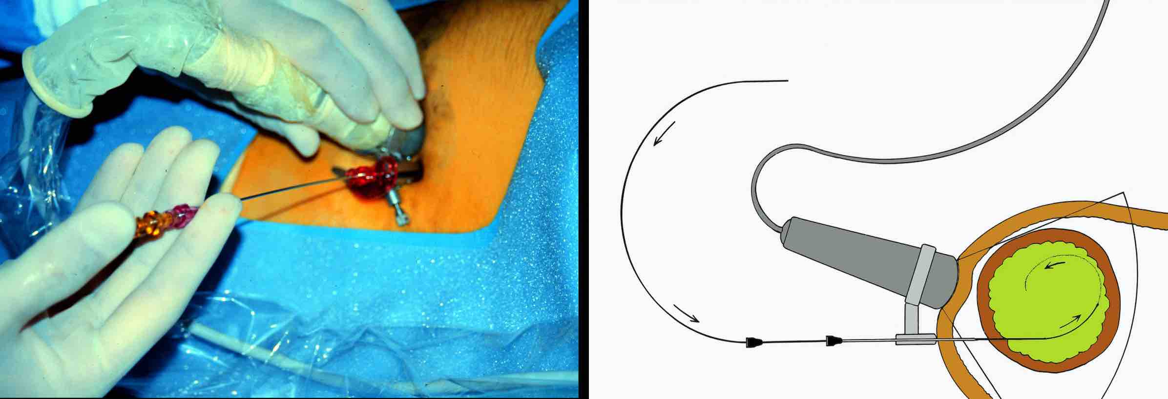 The Radiology Assistant : Appendicitis - US findings
