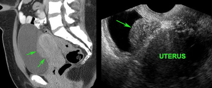 The Radiology Assistant : Transvaginal Ultrasound for Non ...