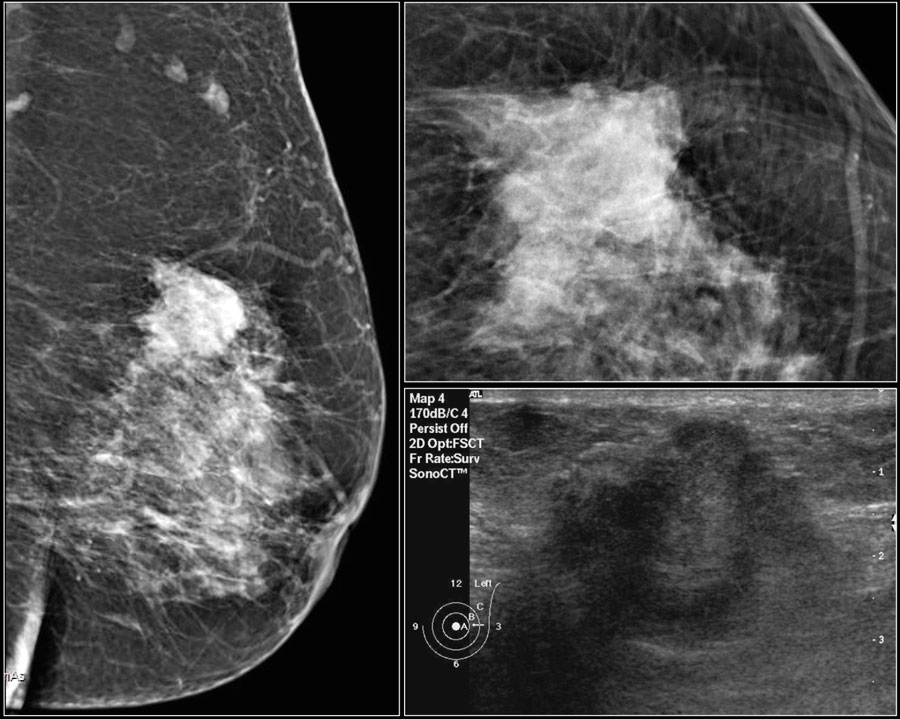 The Radiology Assistant : Bi-RADS for Mammography and Ultrasound 2013