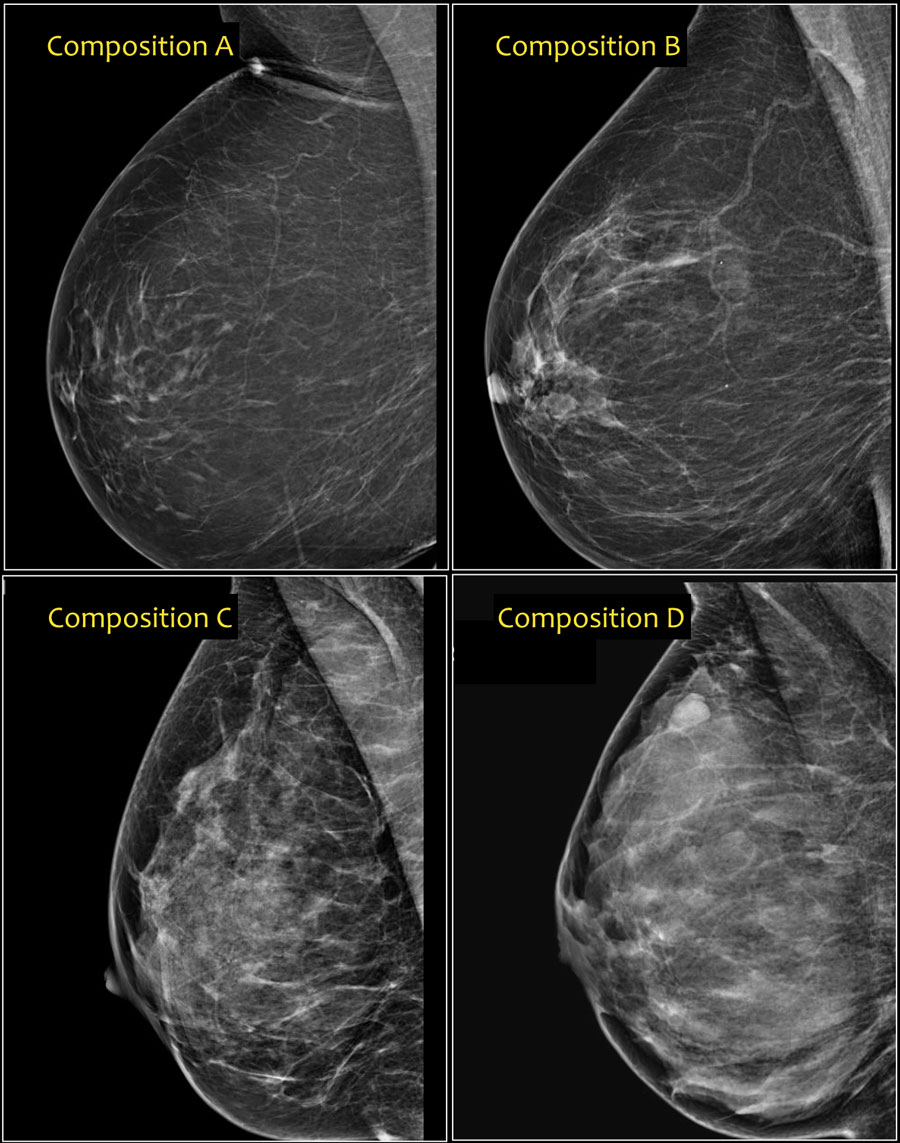 The Radiology Assistant : Bi-RADS for Mammography and Ultrasound 2013