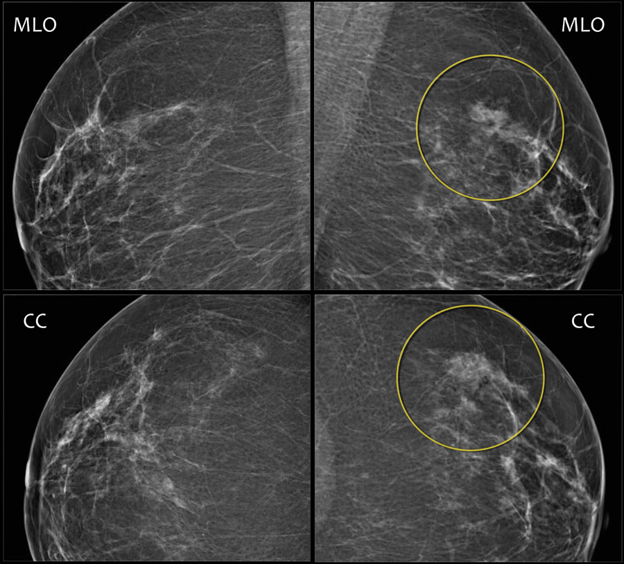 The Radiology Assistant : Bi-RADS for Mammography and Ultrasound 2013