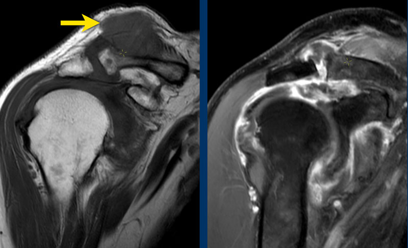 The Radiology Assistant : Shoulder Rotator cuff injury