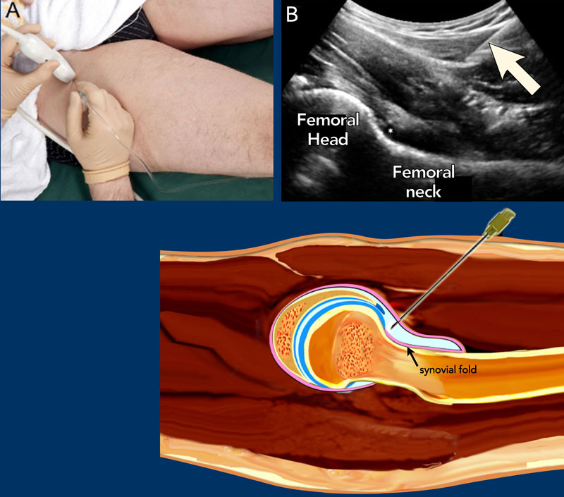 The Radiology Assistant : US-guided injection of joints