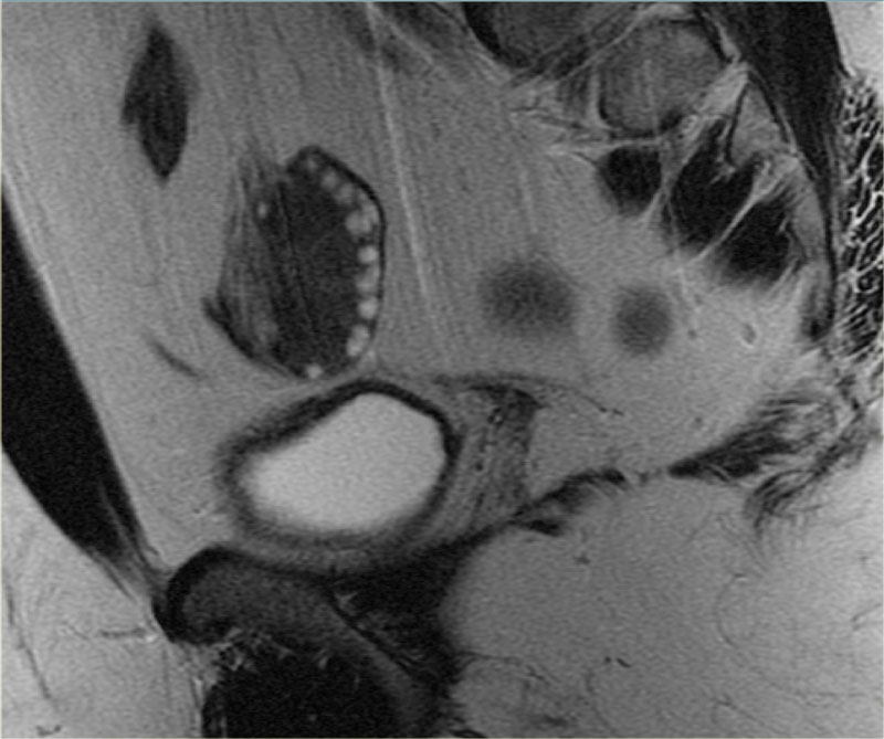 The Radiology Assistant : Ovarian cystic lesions