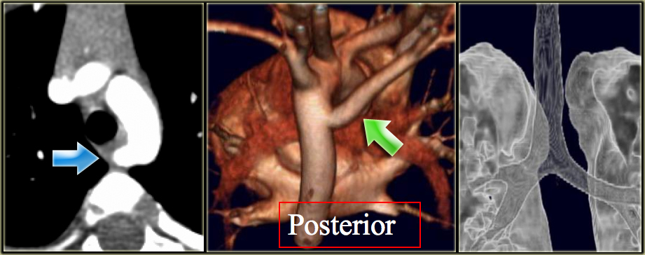 The Radiology Assistant : Vascular Anomalies of Aorta, Pulmonary and ...